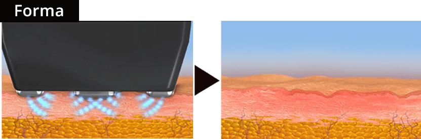 Contouring Excellence: How MiniFX and Forma Work Together