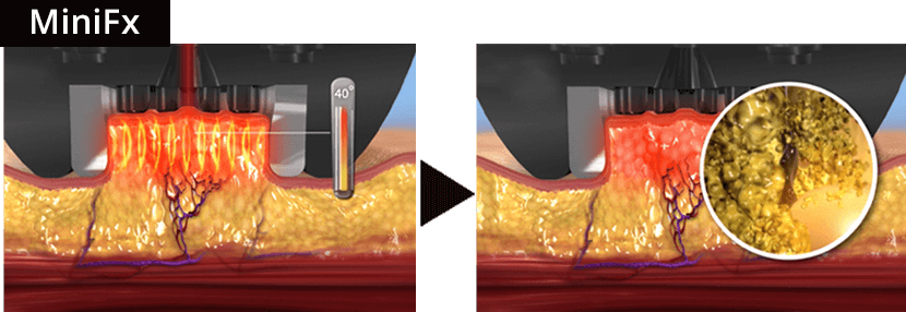 Contouring Excellence: How MiniFX and Forma Work Together